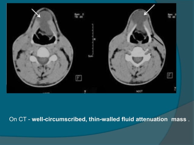 cystic neck lesions congenital and acquired | PPT