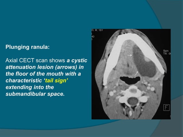 cystic neck lesions congenital and acquired | PPT