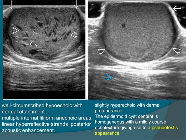 cystic neck lesions congenital and acquired | PPT