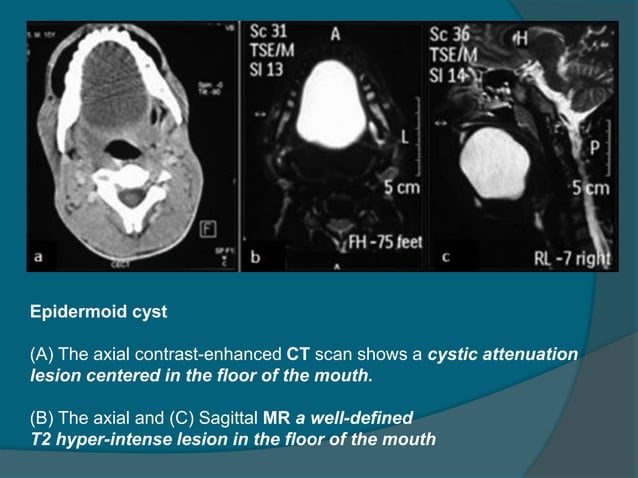 cystic neck lesions congenital and acquired | PPT