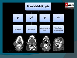 cystic neck lesions congenital and acquired | PPTX