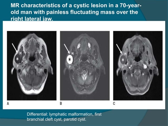 cystic neck lesions congenital and acquired | PPT