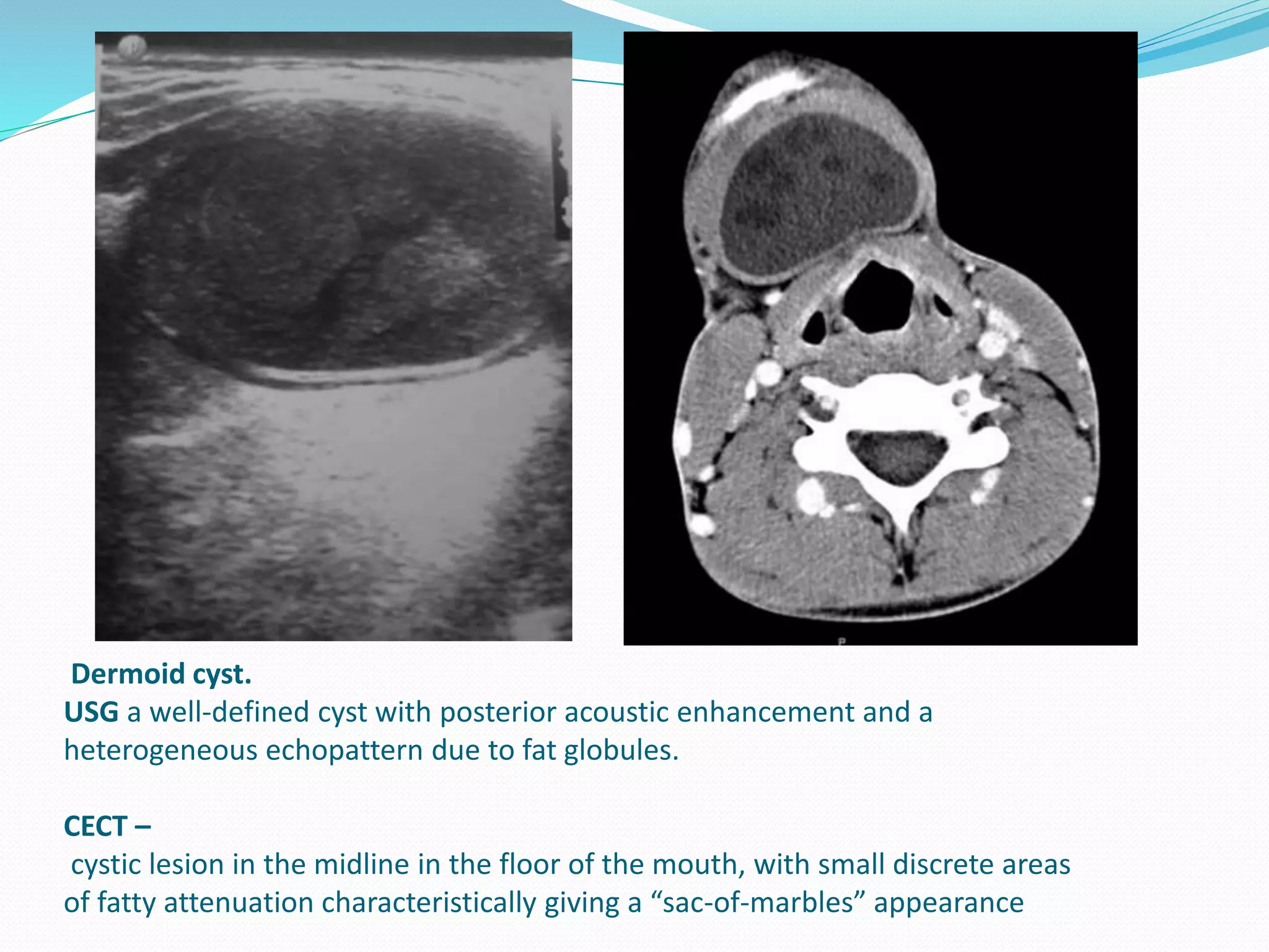 Cystic masses of neck | PPTX