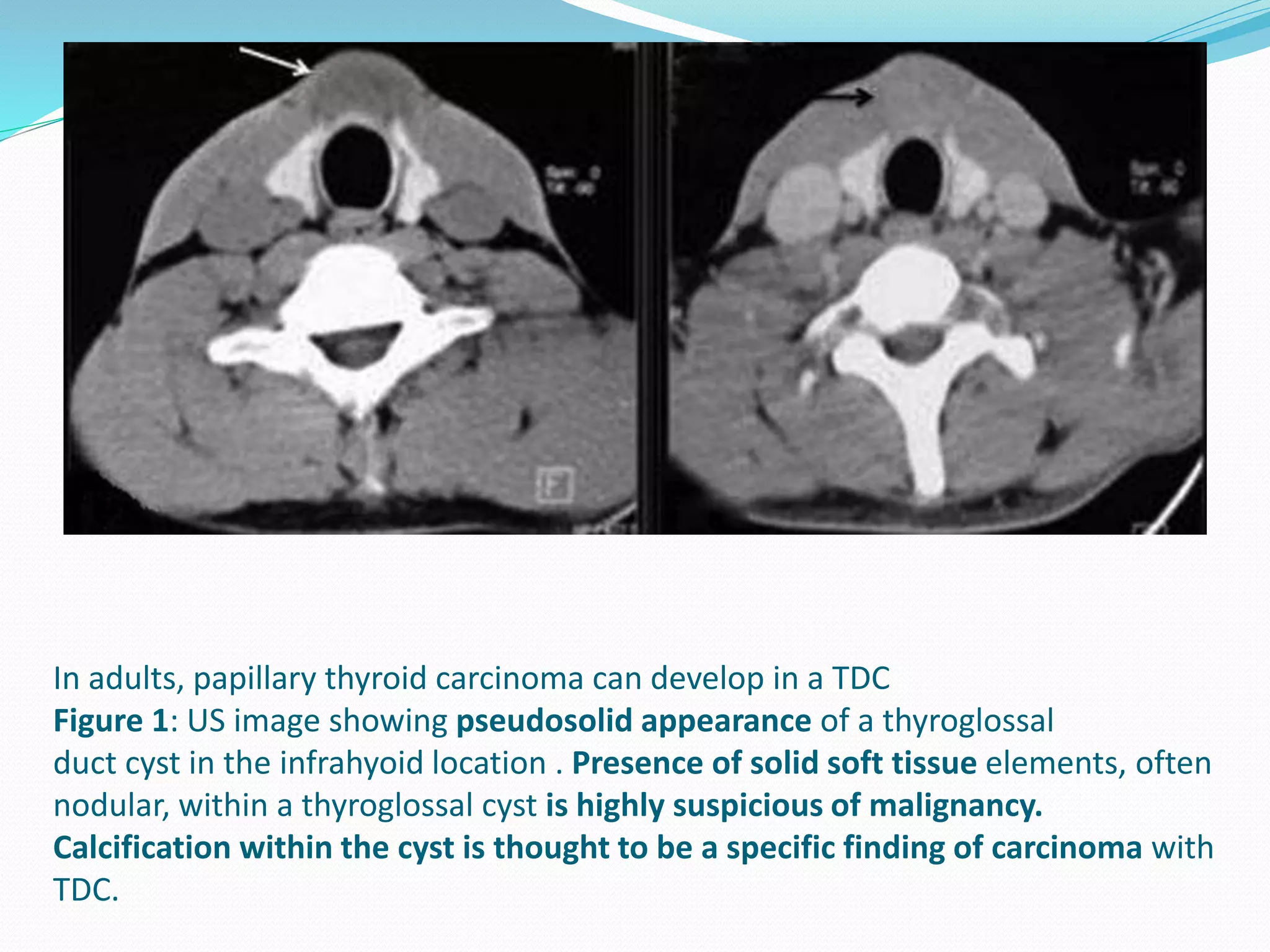 Cystic masses of neck | PPTX