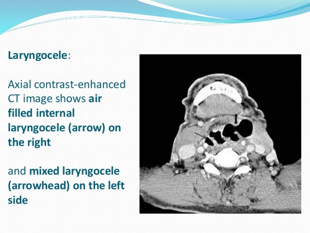 Cystic masses of neck