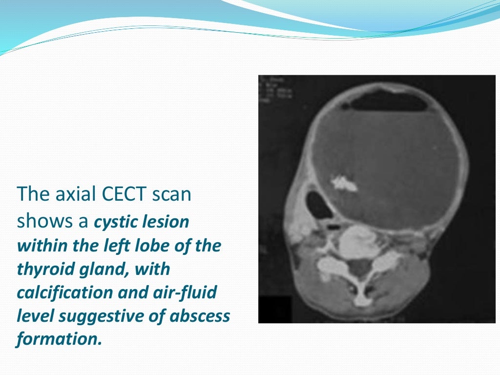 Cystic Masses Of Neck