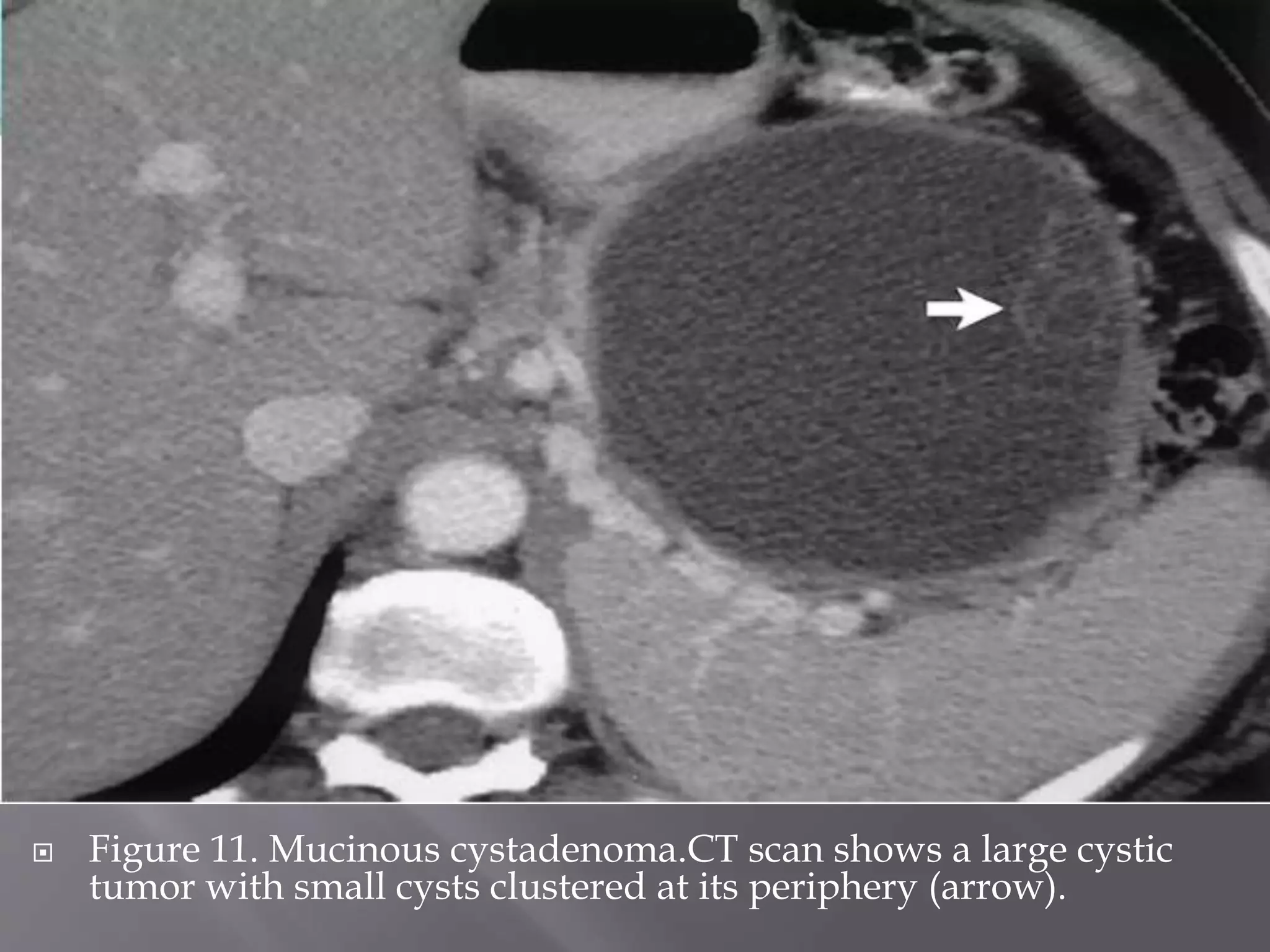 Cystic neoplasm of pancreas | PPTX