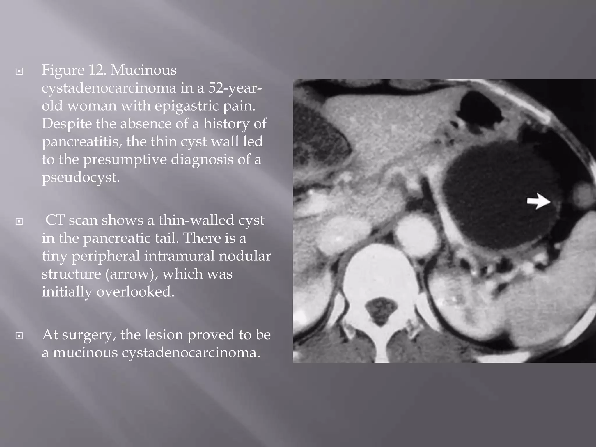 Cystic neoplasm of pancreas | PPTX