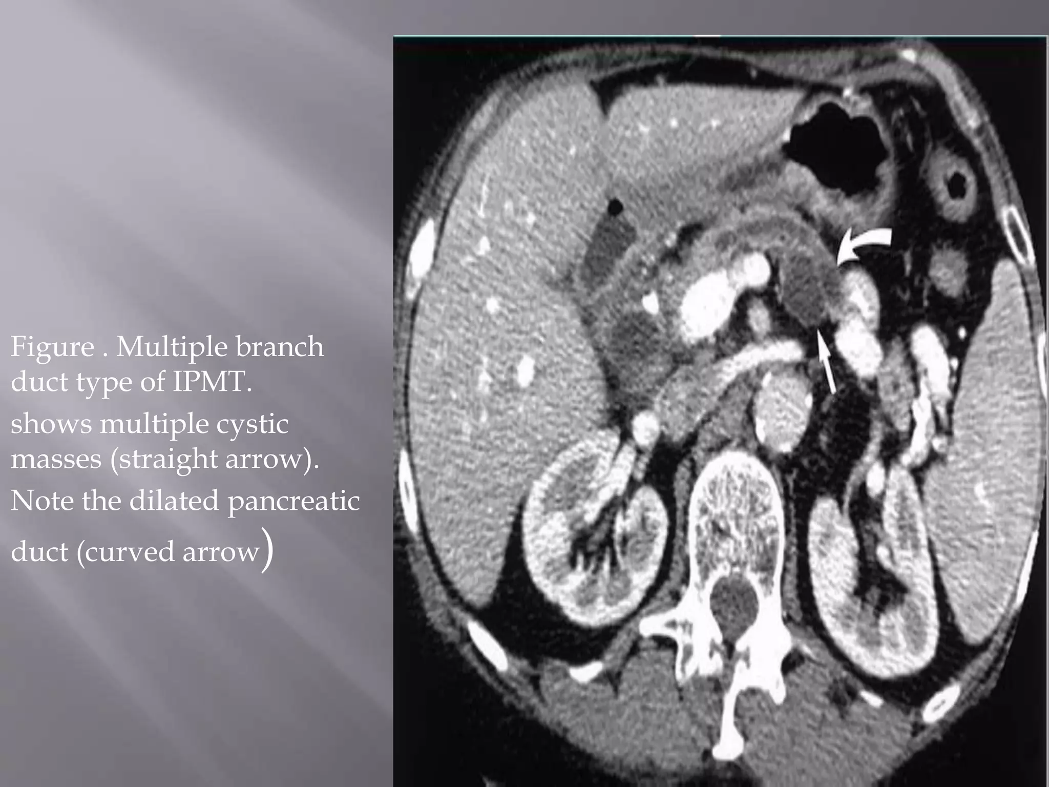 Cystic neoplasm of pancreas | PPTX