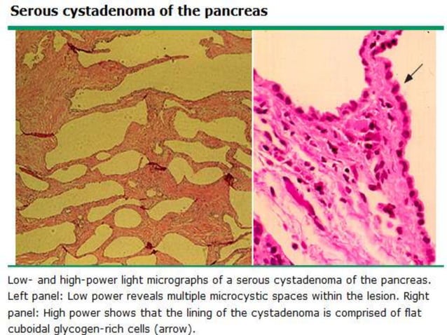 Cystic neoplasm of pancreas | PPTX | Digestive Disorders | Diseases and ...