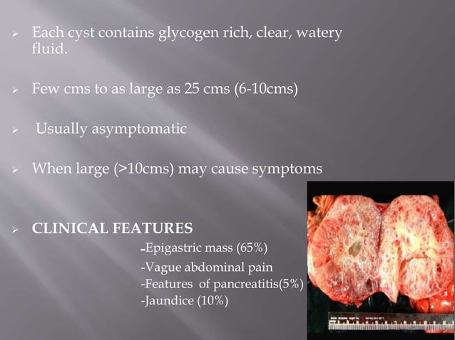 Cystic neoplasm of pancreas | PPTX | Digestive Disorders | Diseases and ...