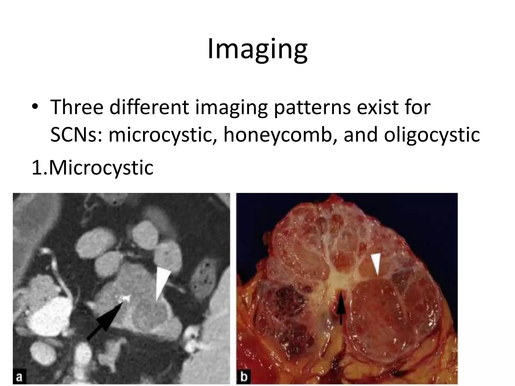 Cystic neoplasm of pancreas | PPTX
