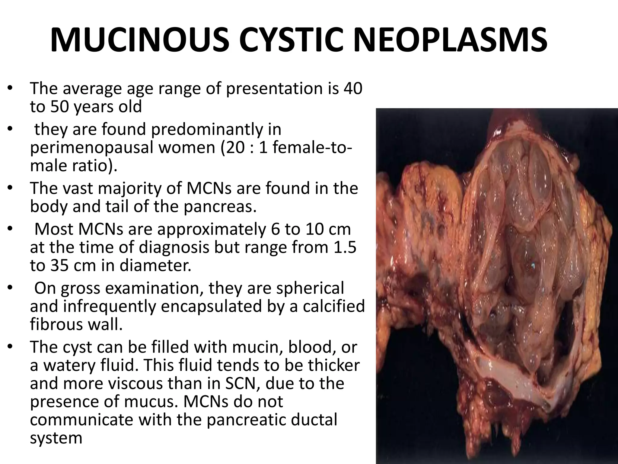 Cystic neoplasm of pancreas | PPTX