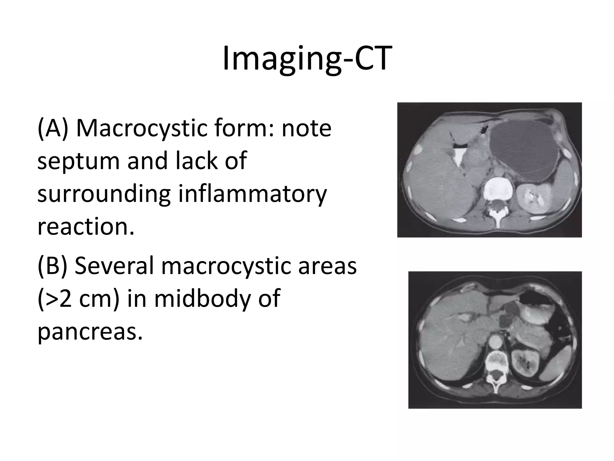 Cystic neoplasm of pancreas | PPTX