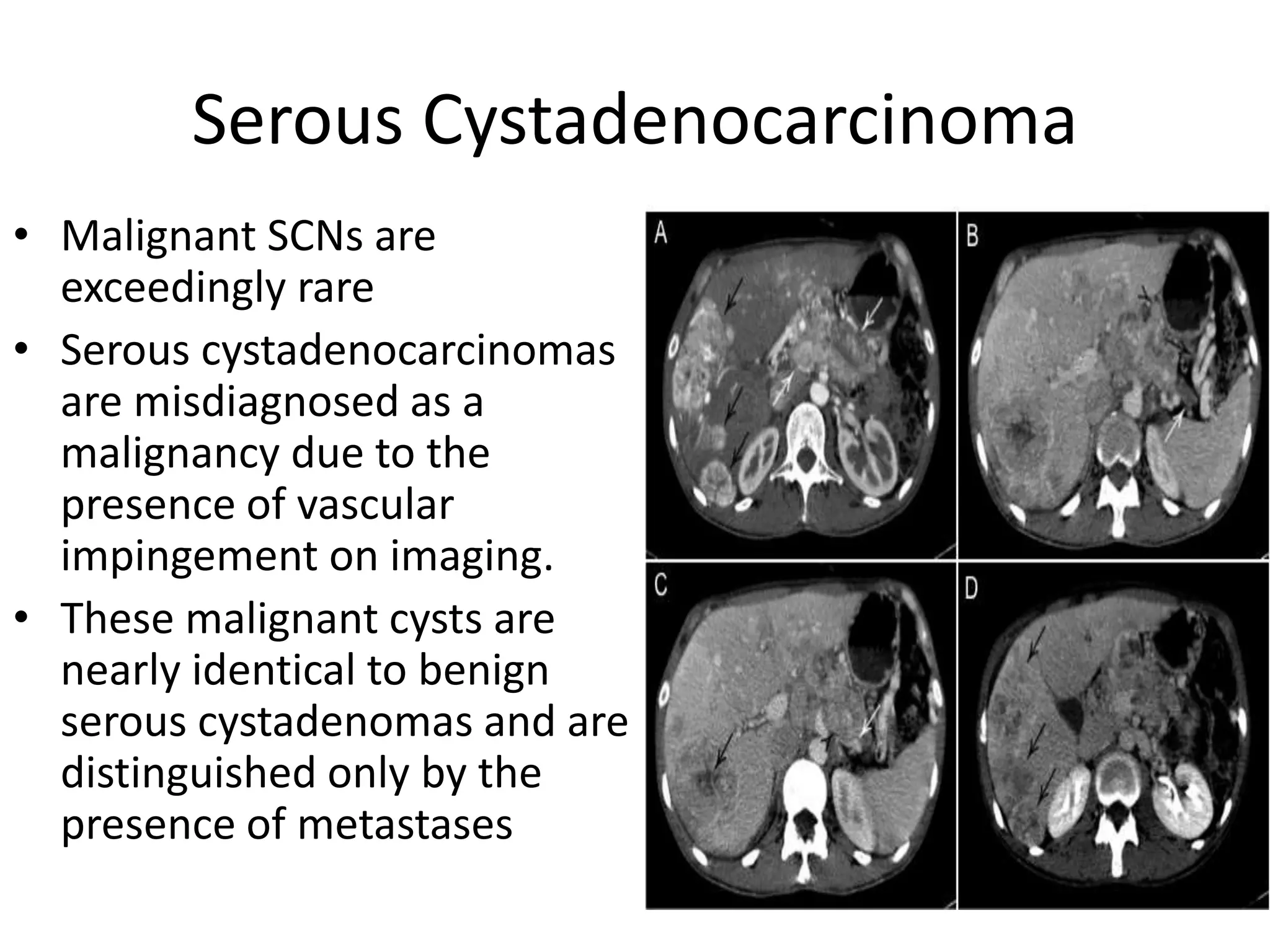 Cystic neoplasm of pancreas | PPTX