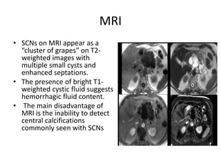 Cystic neoplasm of pancreas | PPTX