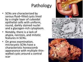 Cystic neoplasm of pancreas | PPTX