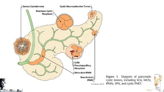 Details about Cystic neoplasm of pancreas.pptx