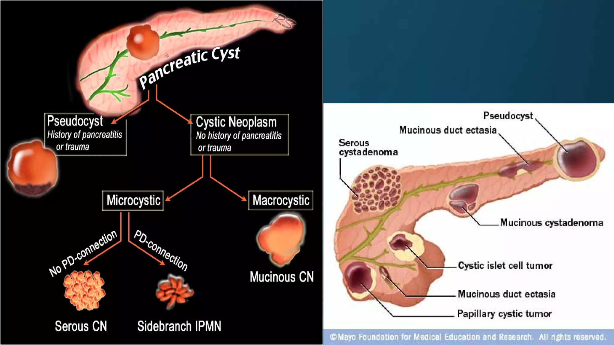 Cystic Neoplasm Of The Pancreas Ppt