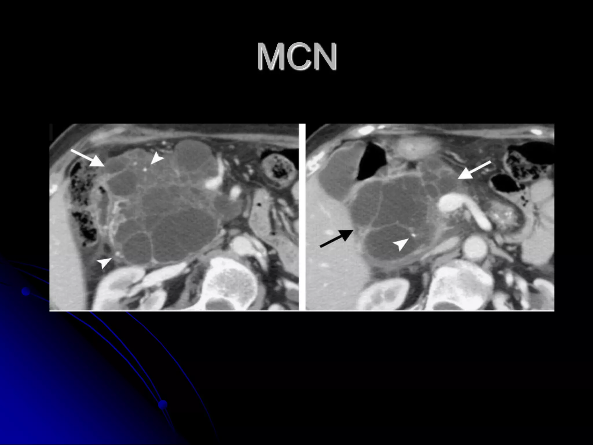 Cystic neoplasm pancreas | PPT