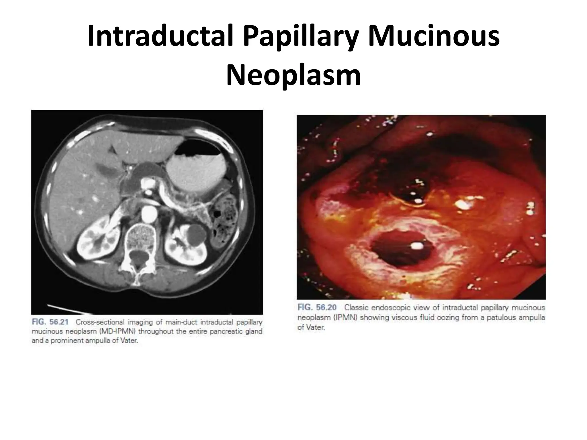 basics on Cystic neoplasms of the pancreas.pptx