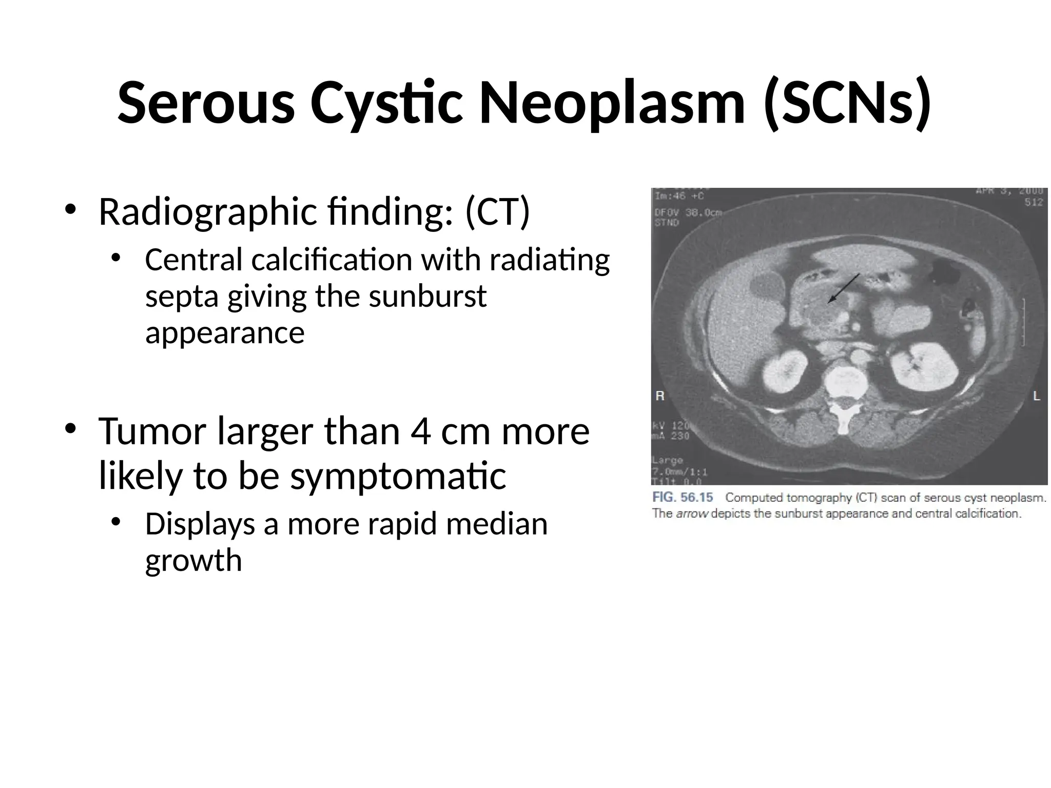 basics of Cystic neoplasms of the pancreas.pptx