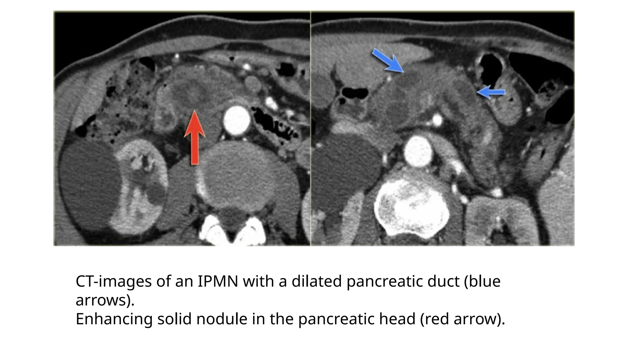 Cystic pancreas lesions power point presentation | PPTX