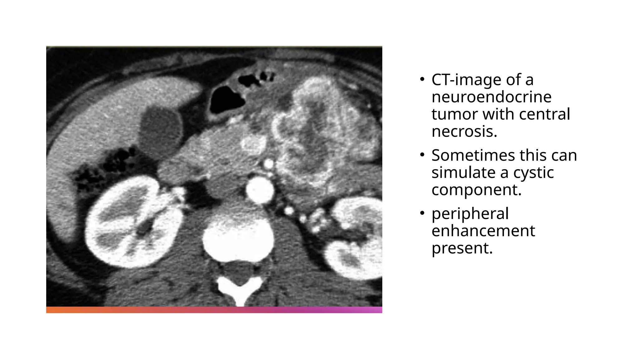 Cystic pancreas lesions power point presentation | PPT
