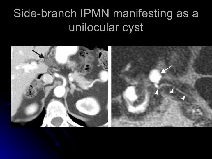 Cystic pancreatic lesions