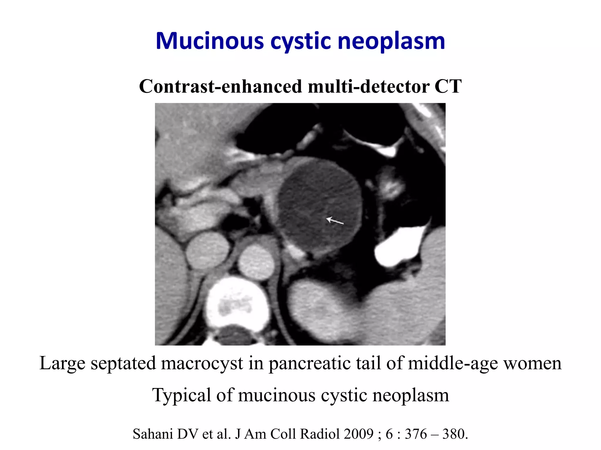 Cystic pancreatic lesions | PPTX