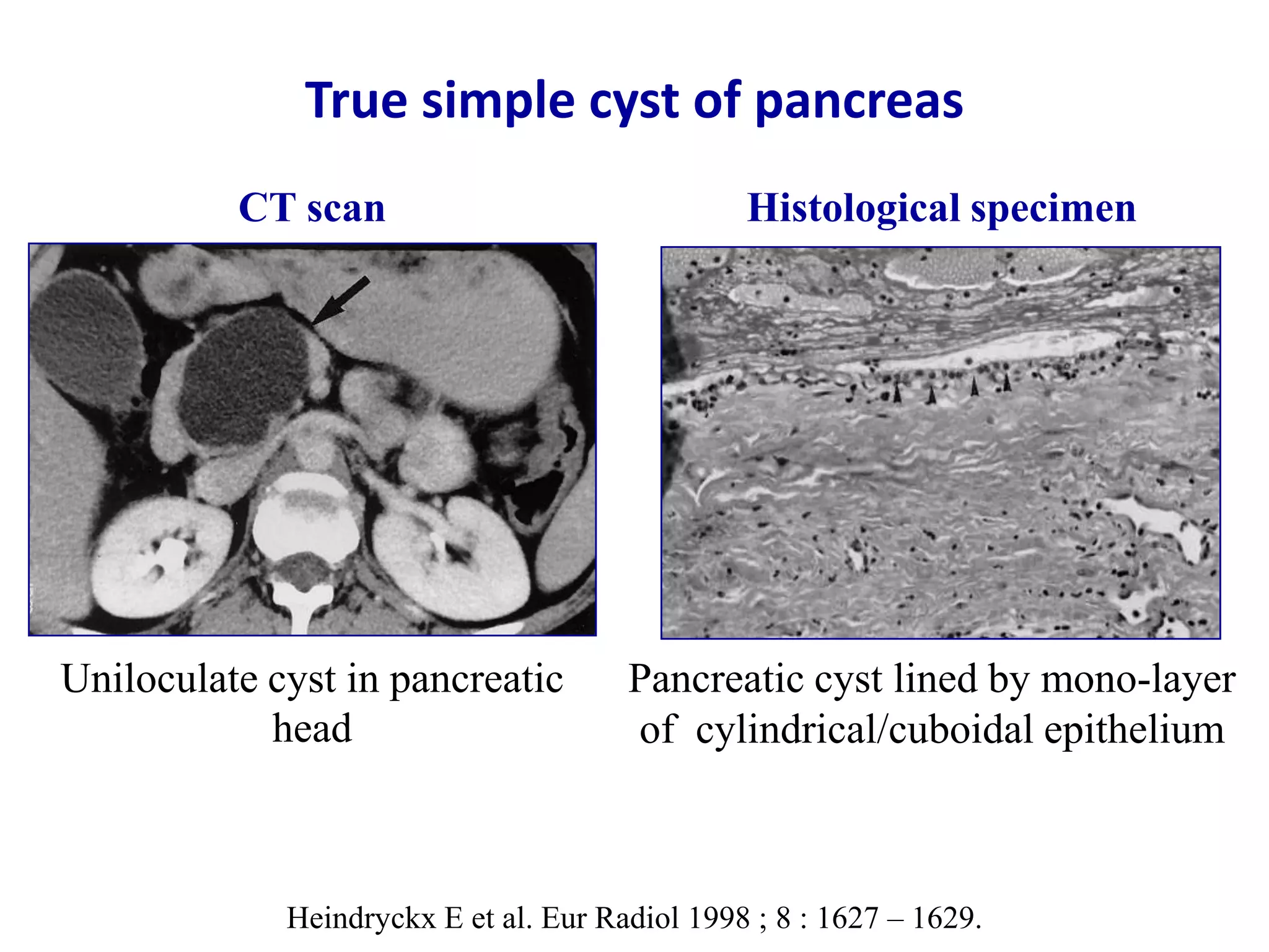 Cystic pancreatic lesions | PPTX