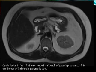 IMAGING OF CYSTIC PANCREATIC TUMOURS | PPTX