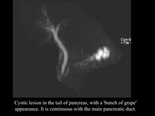 IMAGING OF CYSTIC PANCREATIC TUMOURS | PPTX