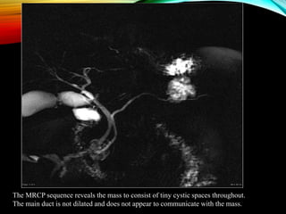IMAGING OF CYSTIC PANCREATIC TUMOURS | PPTX