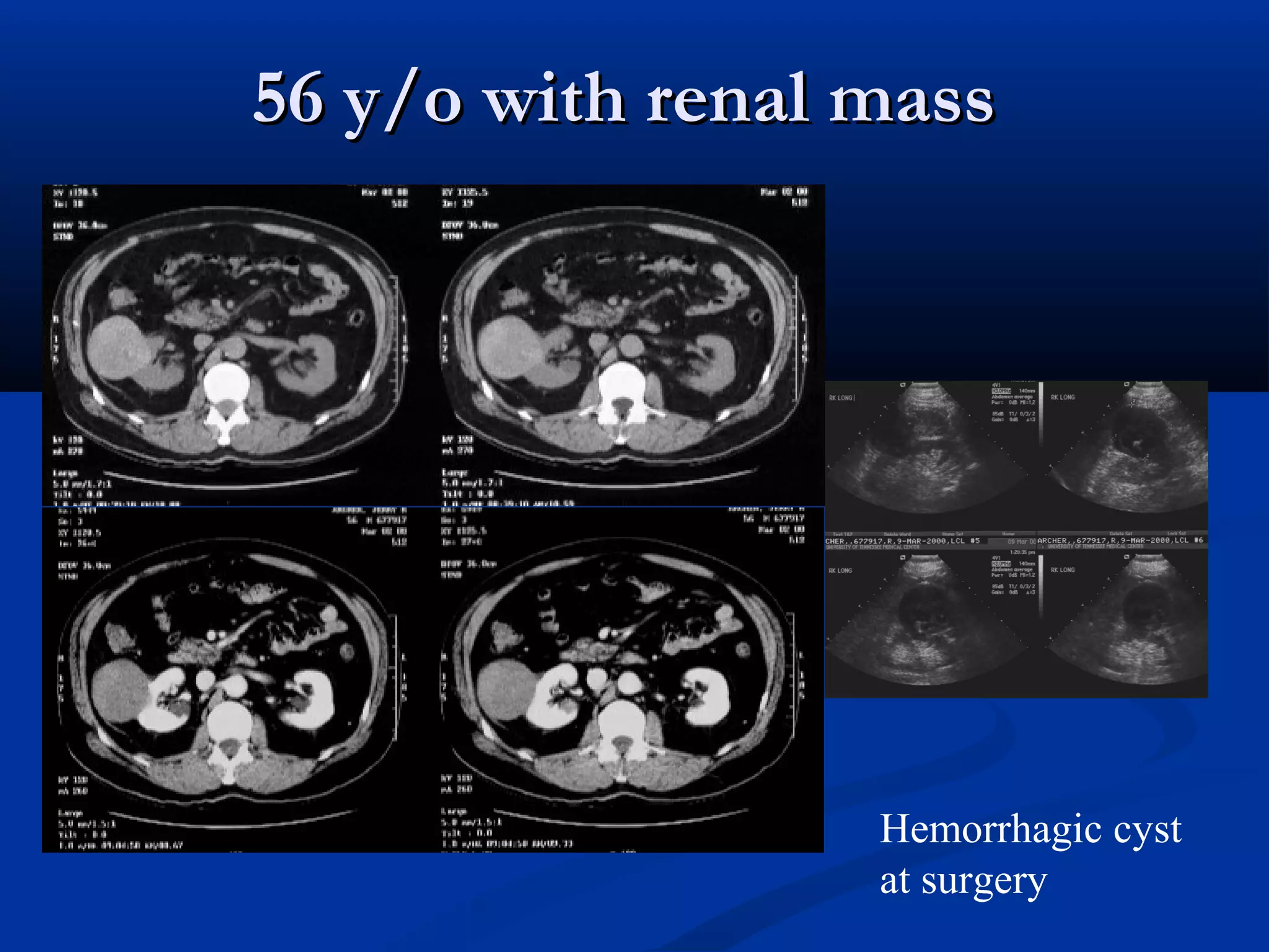 Cystic Renal Disease | PPT