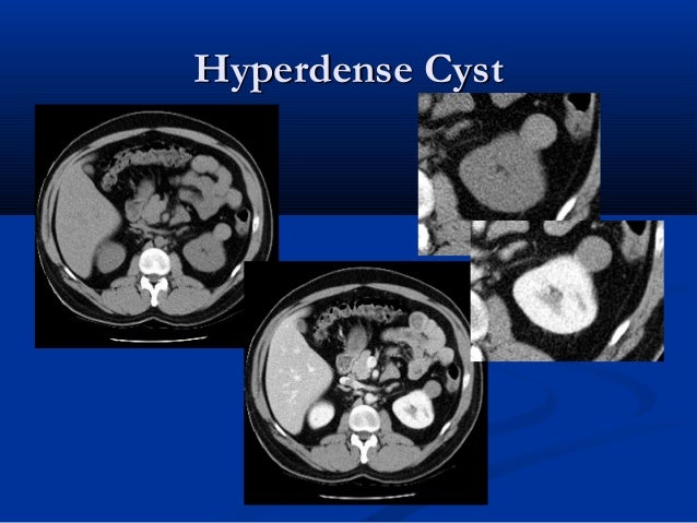 Cystic Renal Disease