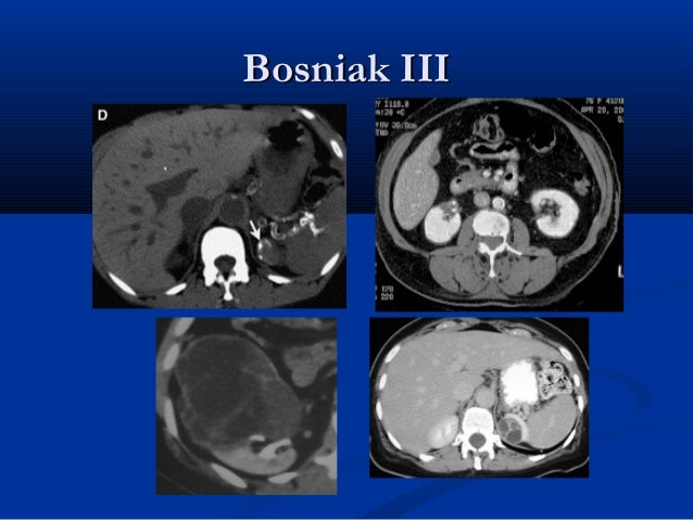 Cystic Renal Disease