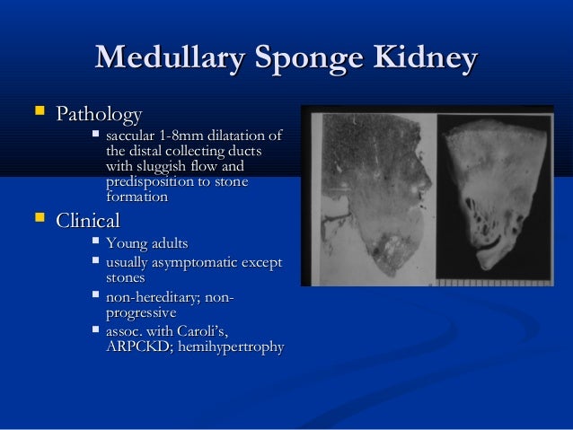 Cystic Renal Disease