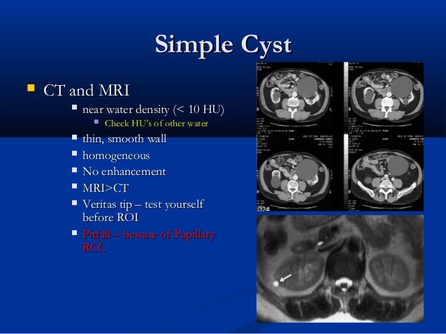 Cystic Renal Disease