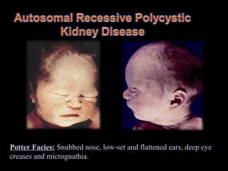 Cystic renal diseases | PPT
