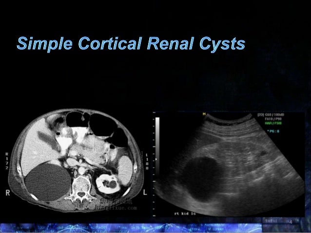 Cystic renal diseases