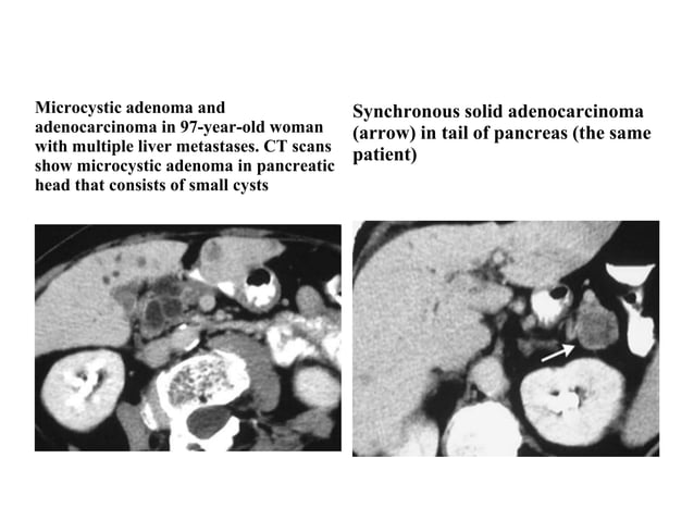 Cystic Tumors Of The Pancreas