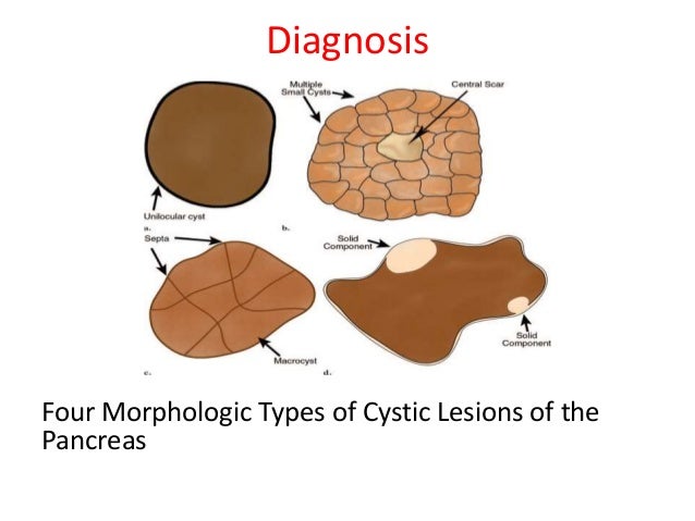 Cystic Tumors Of The Pancreas