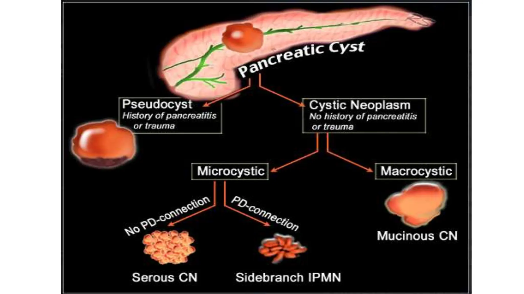 CYSTIC TUMORS OF THE PANCREAS basics.pptx