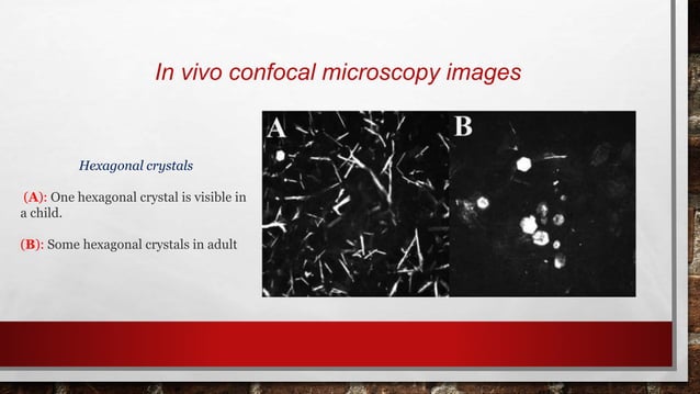 Cystinosis | PPT | Eye and Vision Conditions | Diseases and Conditions