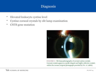 cystinosis-Introduction, diagnosis and management | PPTX