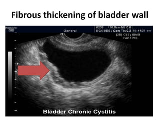 Cystitis made easy | PPTX