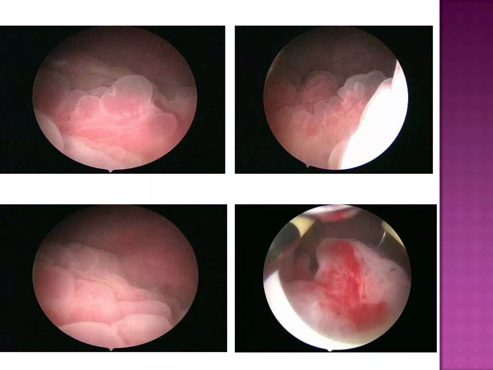 Cystitis Cystica and Glandularis | PPTX