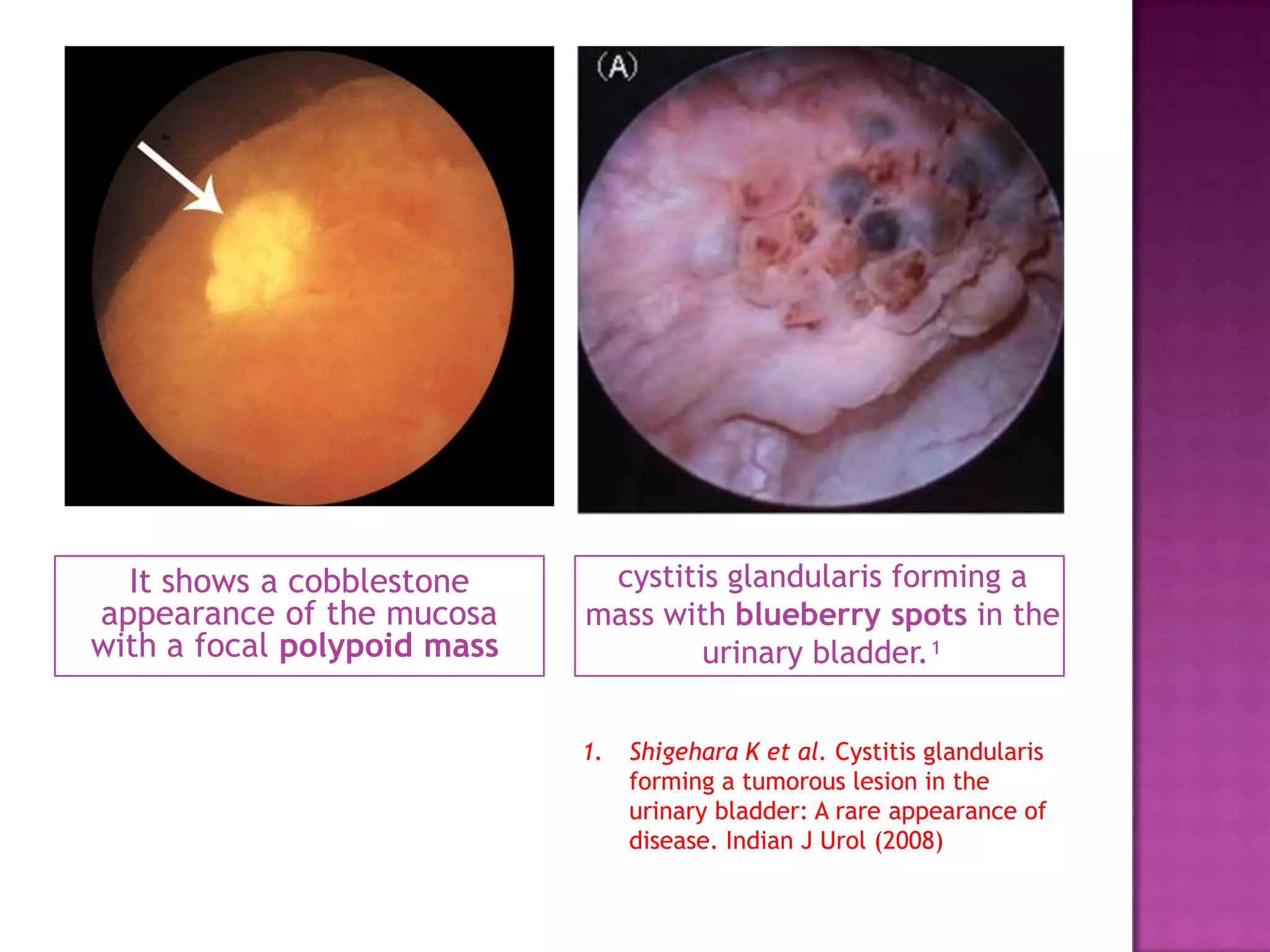 Cystitis Cystica and Glandularis | PPTX