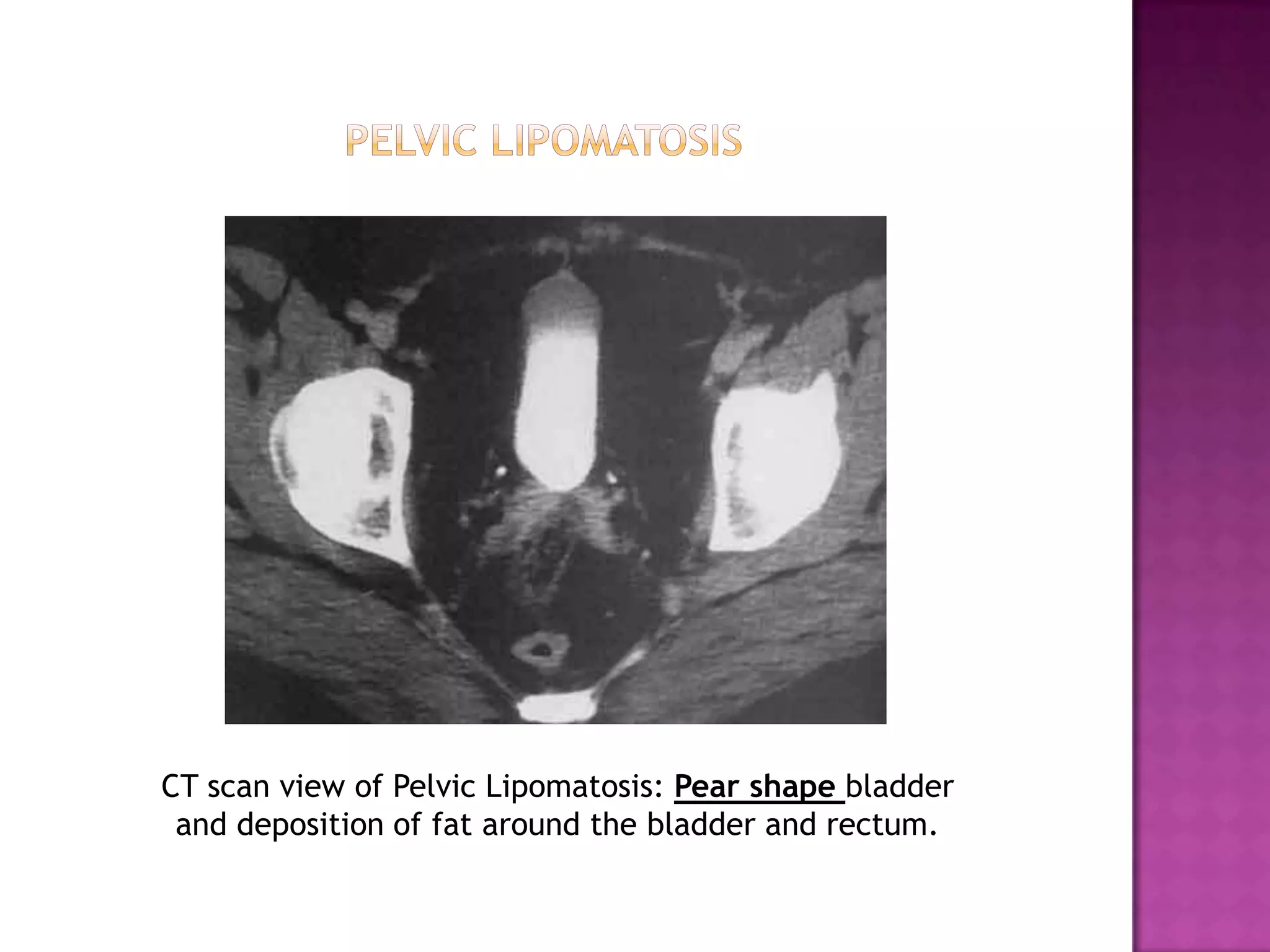 Cystitis Cystica and Glandularis | PPTX